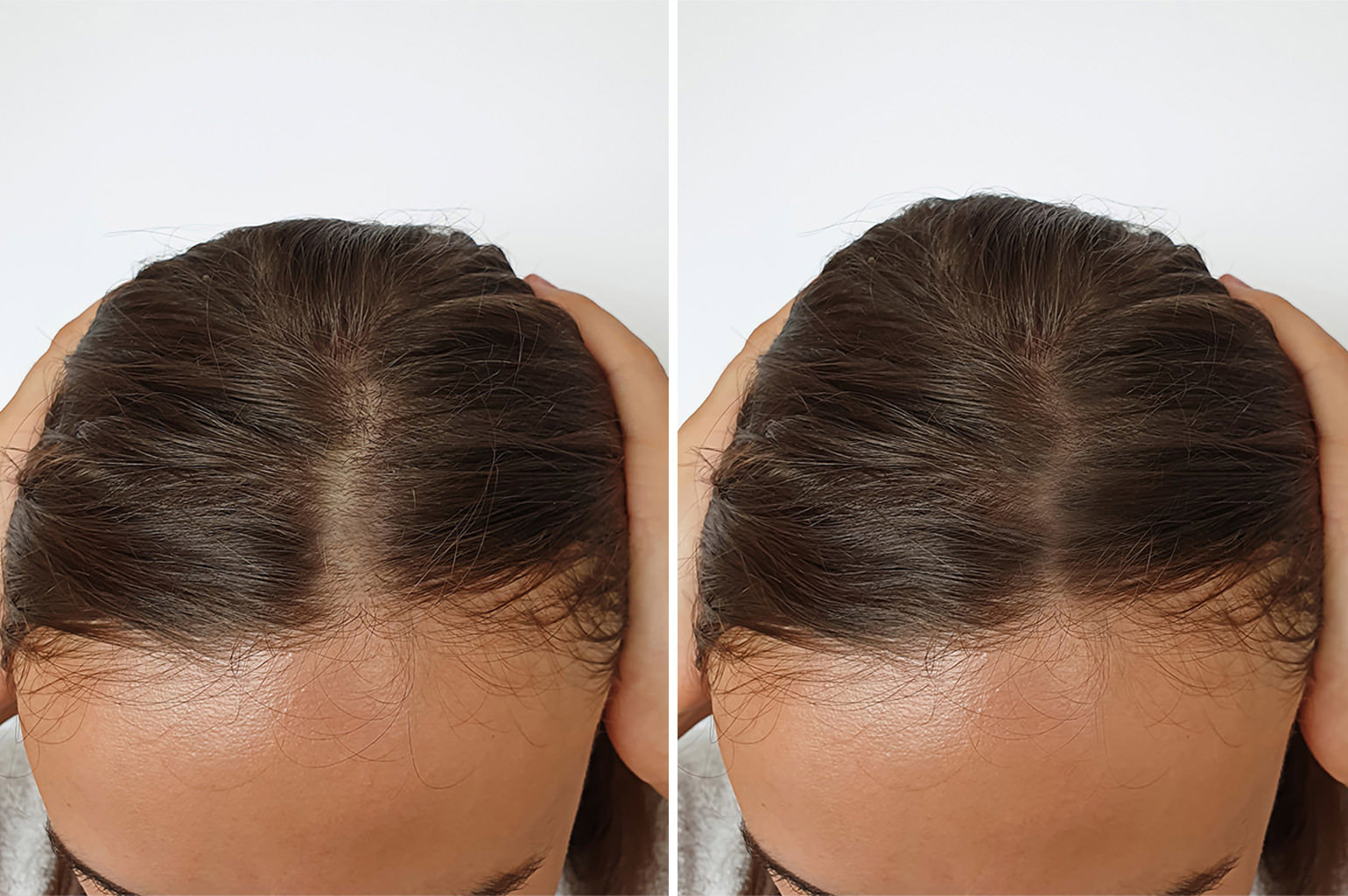 Before & After Hair Restoration